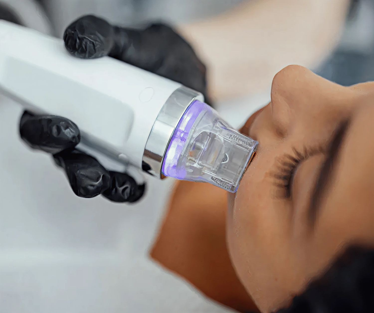 RF Microneedling | Elizabeth MD Facial Plastic Surgery