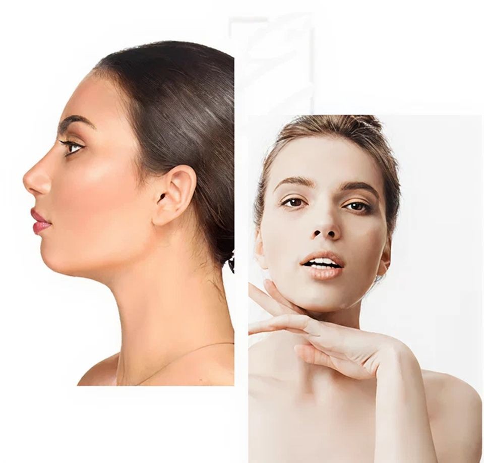 Chin & Cheek Implants Albuquerque | Elizabeth MD Facial Plastic Surgery
